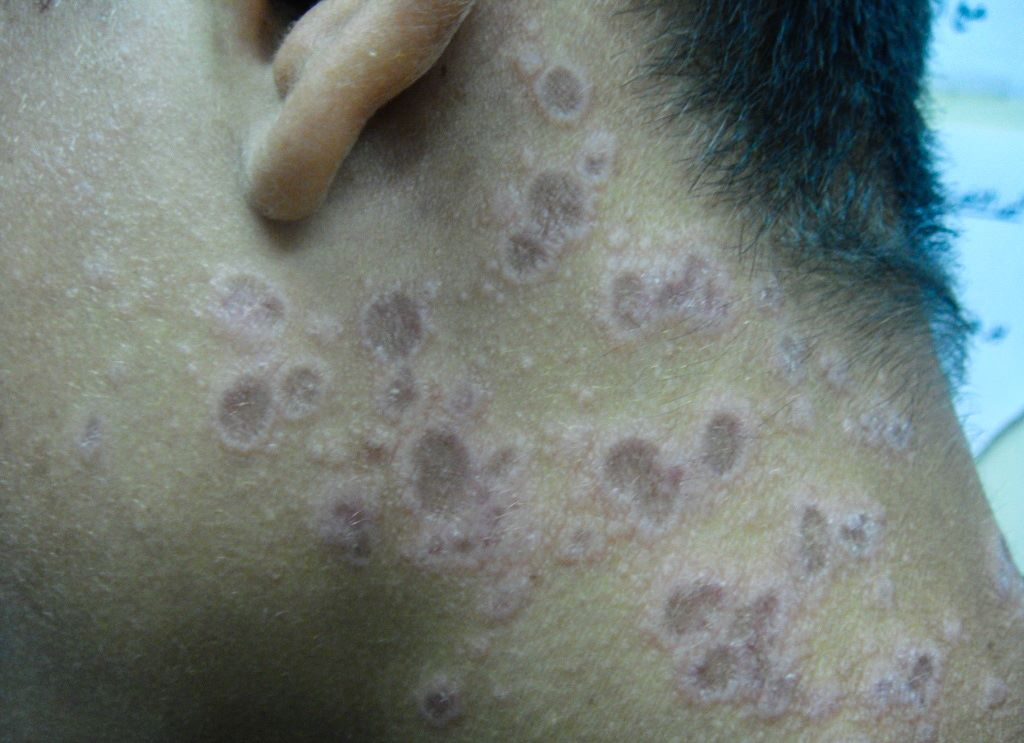 Lichen Planus Actinicus | Dermatology Oasis