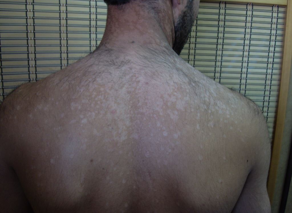 Pityriasis versicolor | Dermatology Oasis