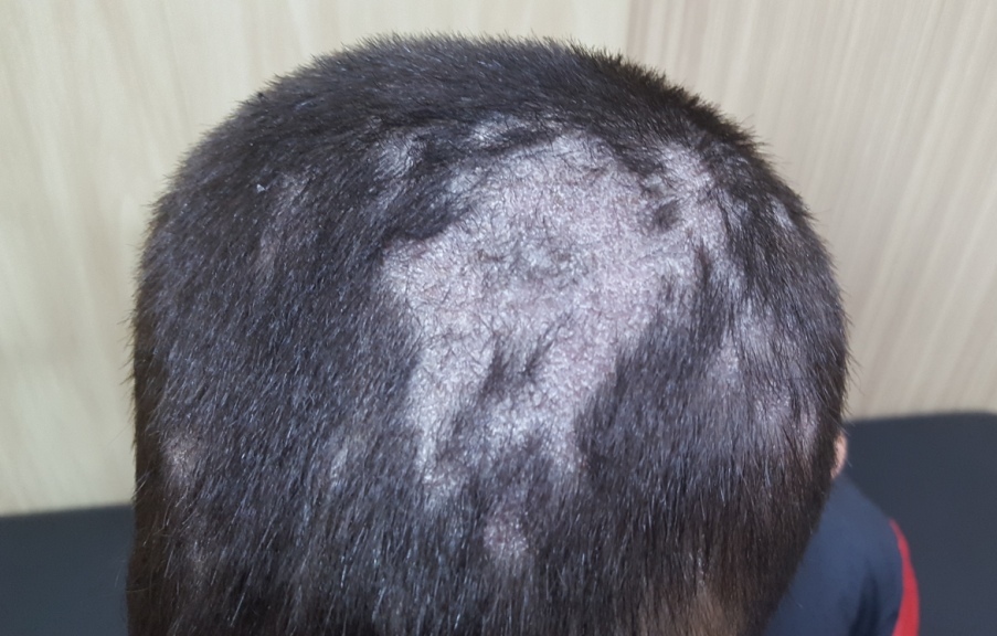 Gray-patch tinea capitis | Dermatology Oasis
